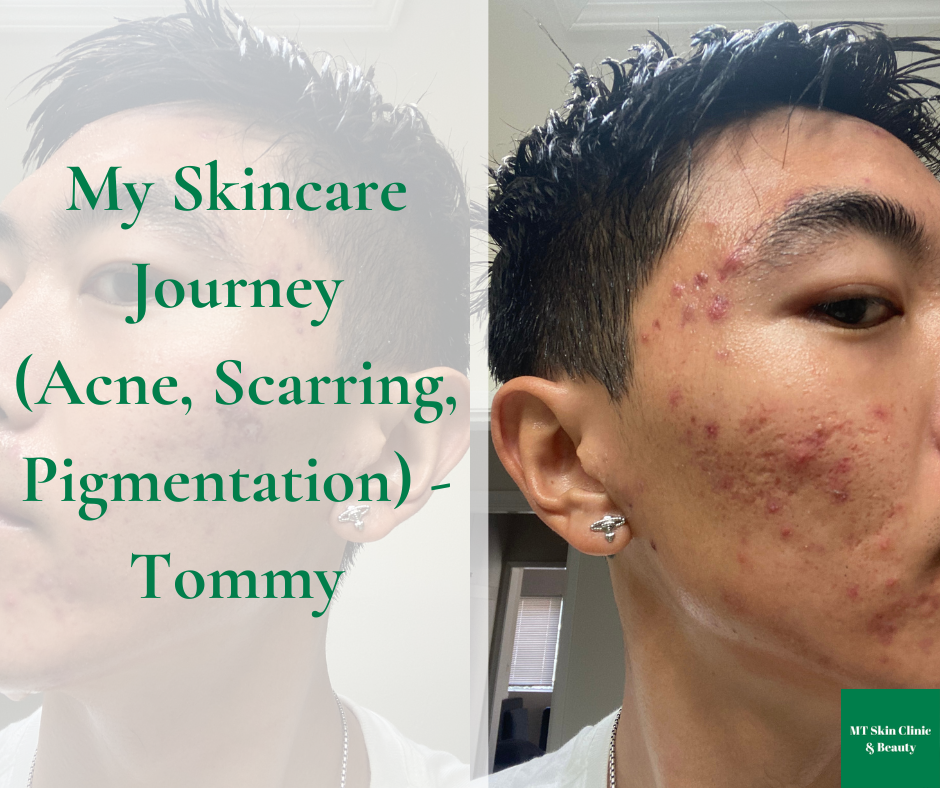 My Skincare Journey (Acne, Scarring, Pigmentation) - Tommy - MT Skin Clinic